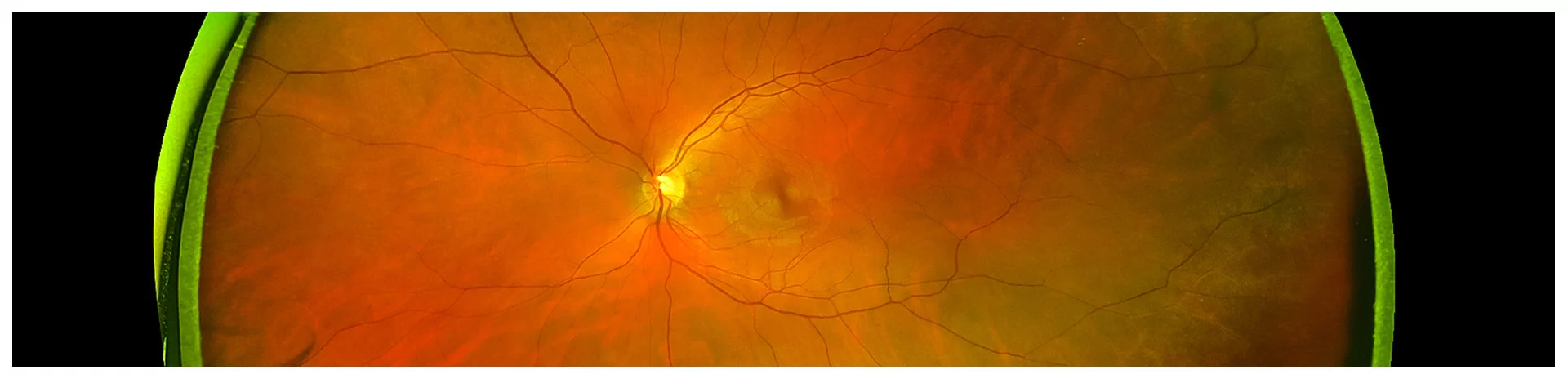 Retina | Conditions & Treatments | UCHealth